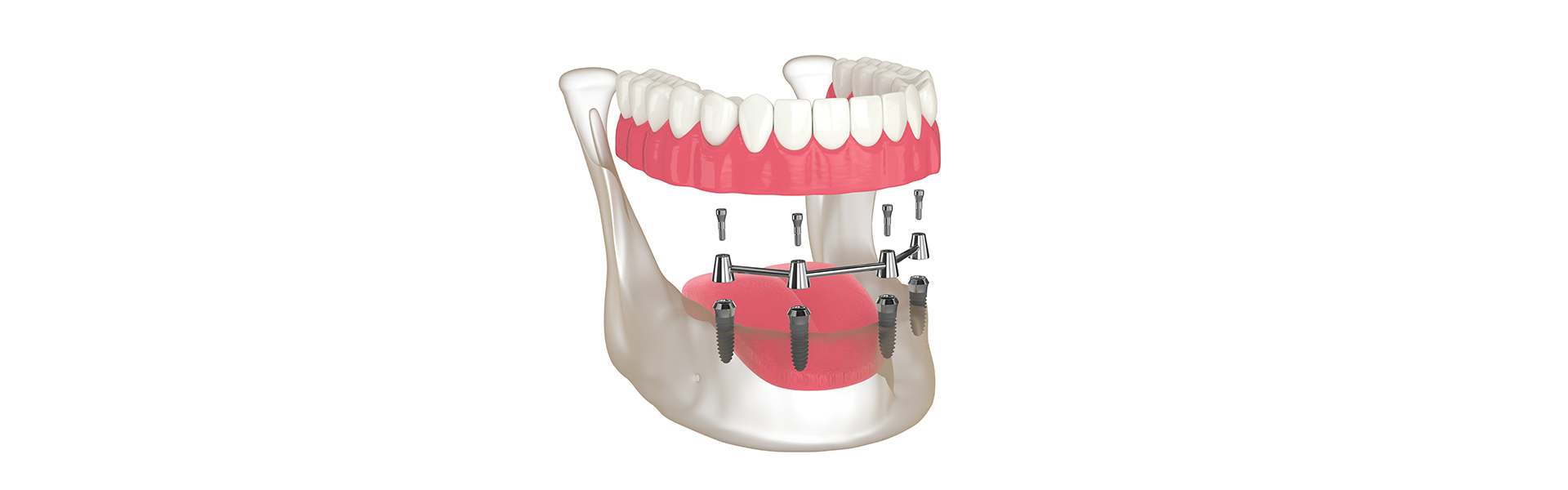 All-on-4® Dental Implants in Milford | Implant Clinic Near You